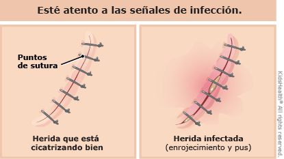 De qué sirven los puntos de sutura