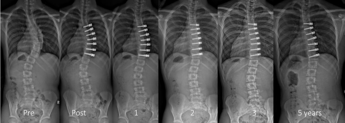 Spinal Growth Tethering Prevents Fusion in the Majority | Rady Children ...