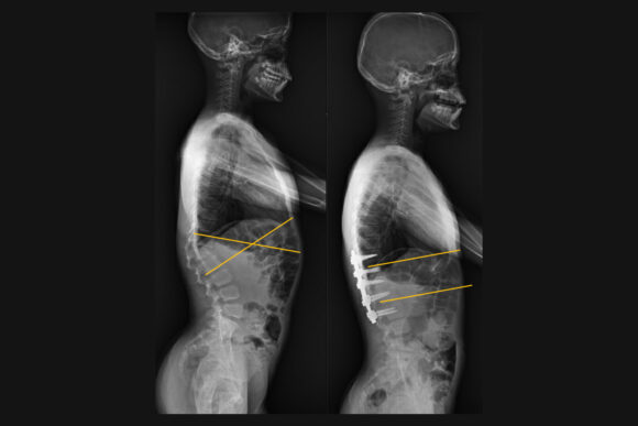 New Research Sheds Light on Defining Normal Sagittal Spinal Alignment ...