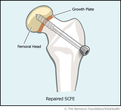 Slipped Capital Femoral Epiphysis (SCFE)